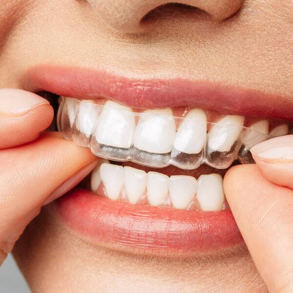 ¿Para qué se utiliza un expansor de paladar en ortodoncia? - Clínica de ...